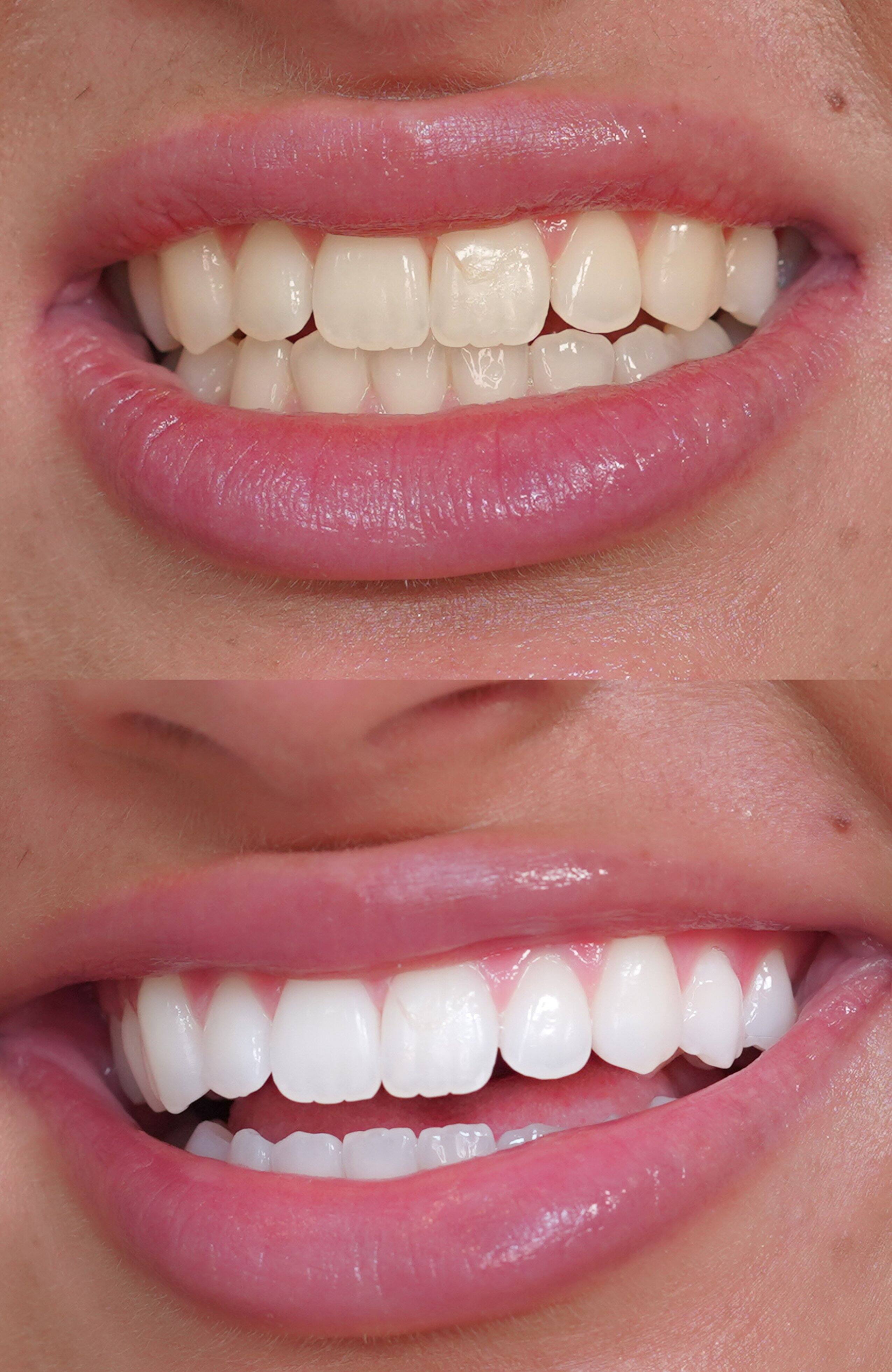 Customer Reviews: Snow Diamond Teeth Whitening Kit White 100-0016 ...