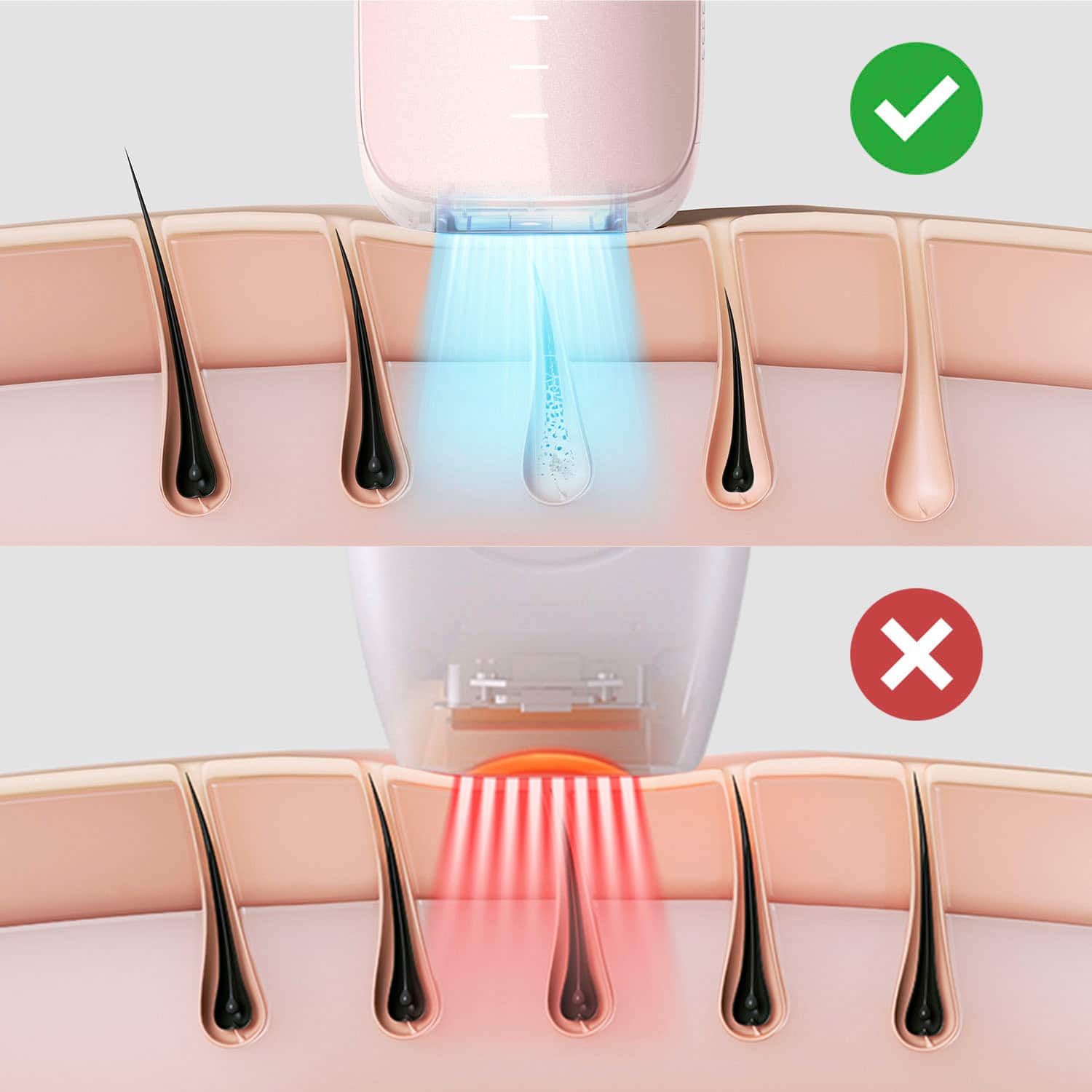 Ulike Ice Cooling At Home Hair Removal Device Air 3 Pink Ui06 Pn Best Buy